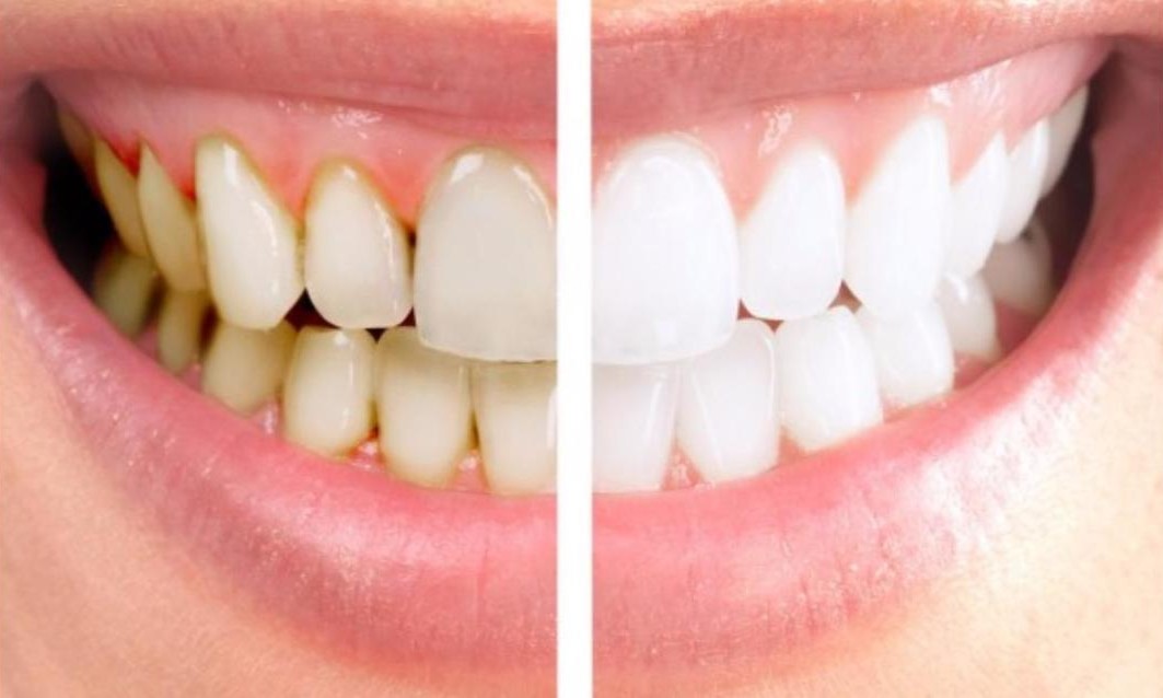 Teeth Scaling and Polishing in Riyadh , Saudi Arabia | Get a Perfect Smile