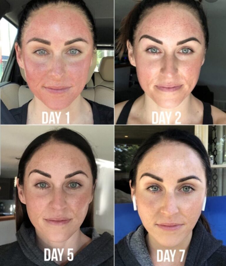 Derma Pen in Riyadh: The Secret to Flawless Skin