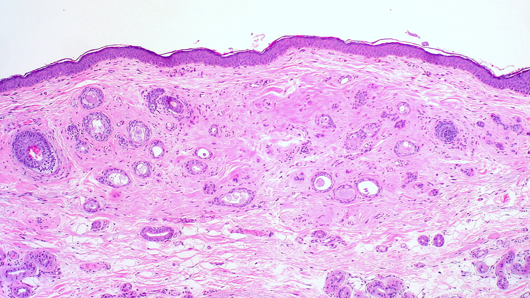 Syringoma Removal in Riyadh - Enfield Royal Saudia