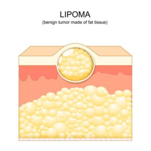 Lipoma Treatment in Riyadh - Enfield Royal Saudia