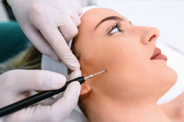 Mole Removal in Riyadh - Enfield Royal Saudia