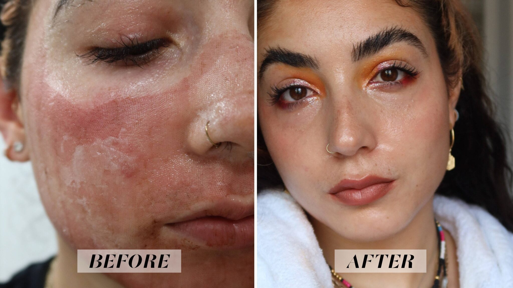 Fractional Laser Treatment In Riyadh Enfield Royal Saudia