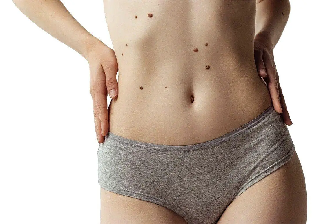 Warts Removal Surgery Pros And Cons