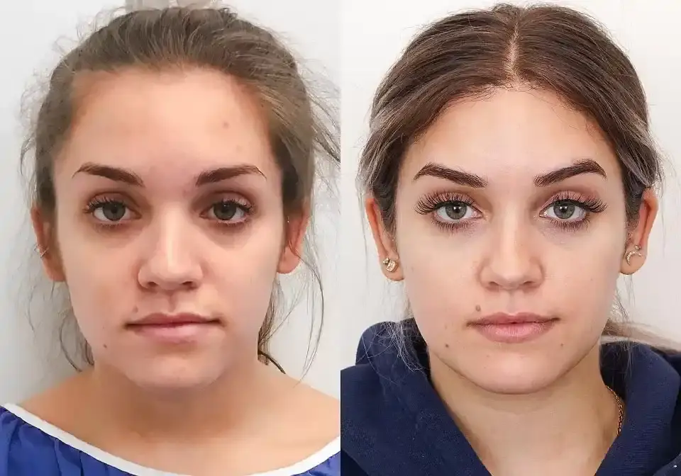 Eyebrow Lift in Riyadh, Jeddah, Saudi Arabia (Get the Best Results)