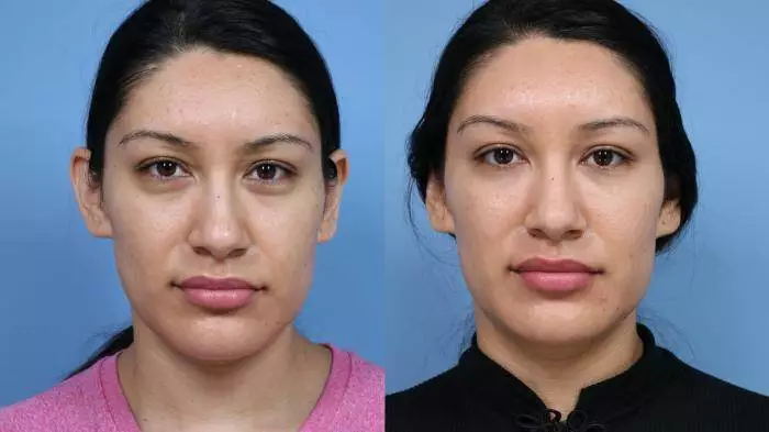 Dermal Fillers in Riyadh