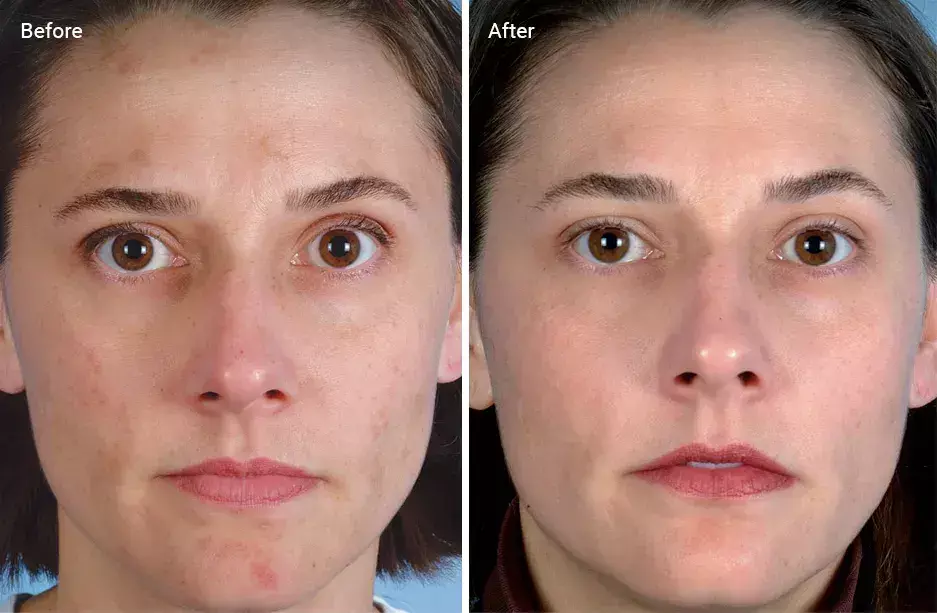 Diamond Peel in Riyadh, Jeddah Saudi Arabia- Enfield Royal Clinic