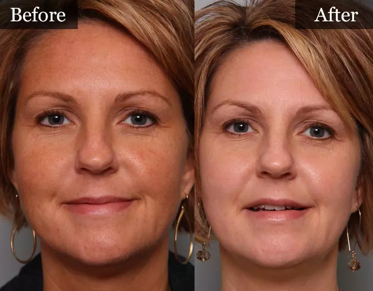 Diamond Peel in Riyadh, Jeddah Saudi Arabia- Enfield Royal Clinic