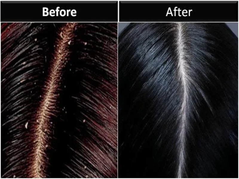 Severe Dandruff Treatment in Riyadh, Jeddah, Saudi Arabia-ERC