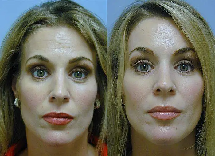 Eyebrow Lift in Riyadh, Jeddah, Saudi Arabia (Get the Best Results)