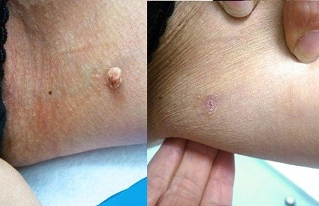 Preauricular Tag Removal in Riyadh-Enfield Royal Clinic Saudi
