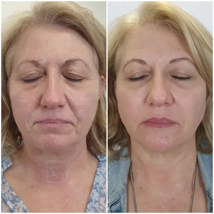 Skin Tightening and Body Contouring in Riyadh, Jeddah, Saudi Arabia