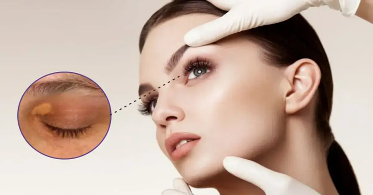 Eyelid Xanthelasma Removal in Riyadh, Jeddah, Saudi Arabia -Cost