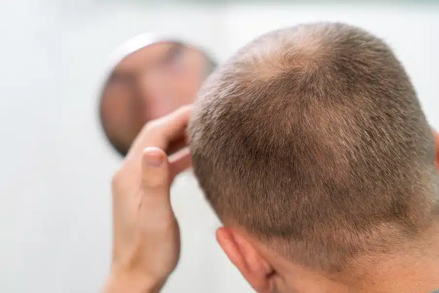 FUSS Hair Transplant in Riyadh | Cost and Prices