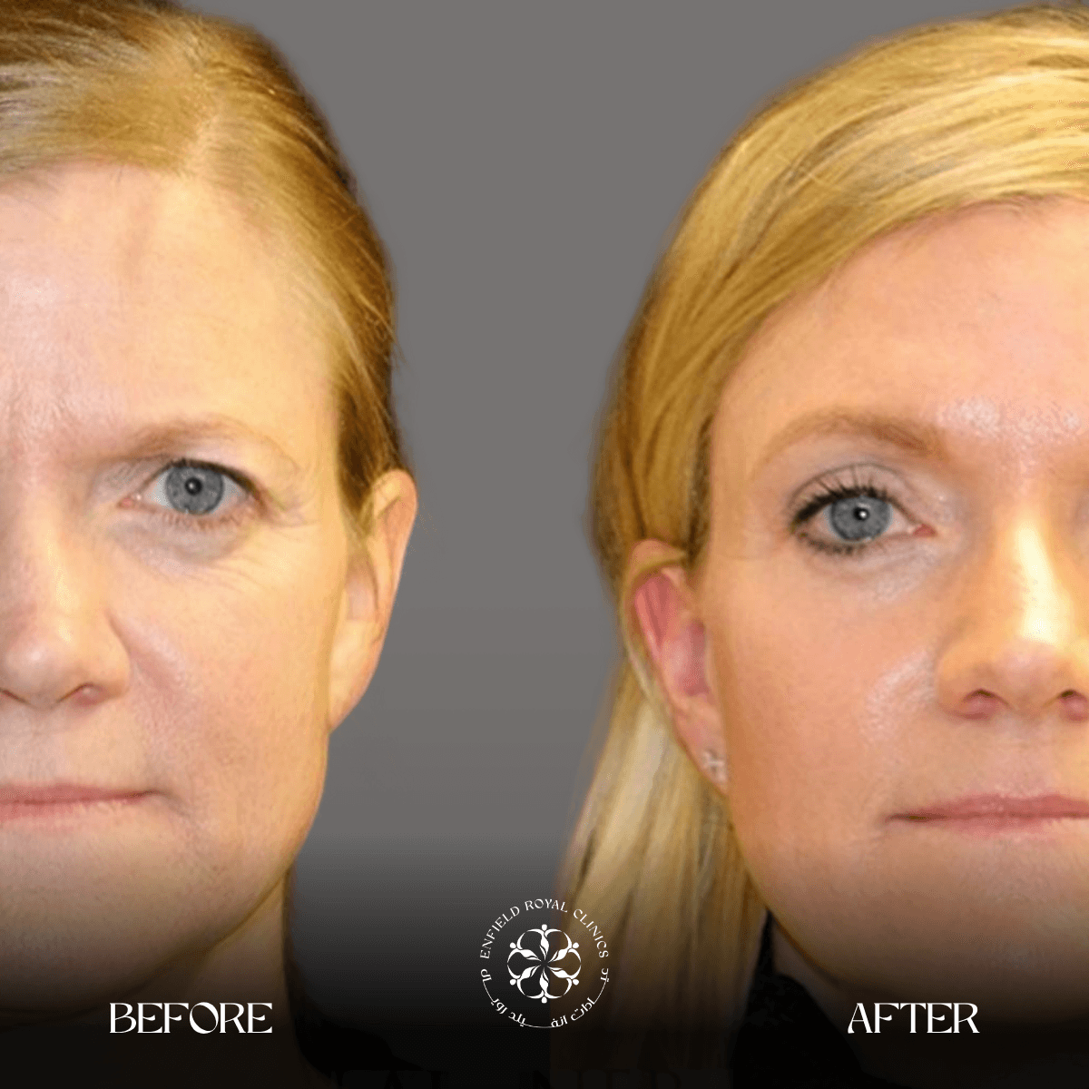 Eyelid Surgery in Riyadh & Saudi Arabia | Blepharoplasty