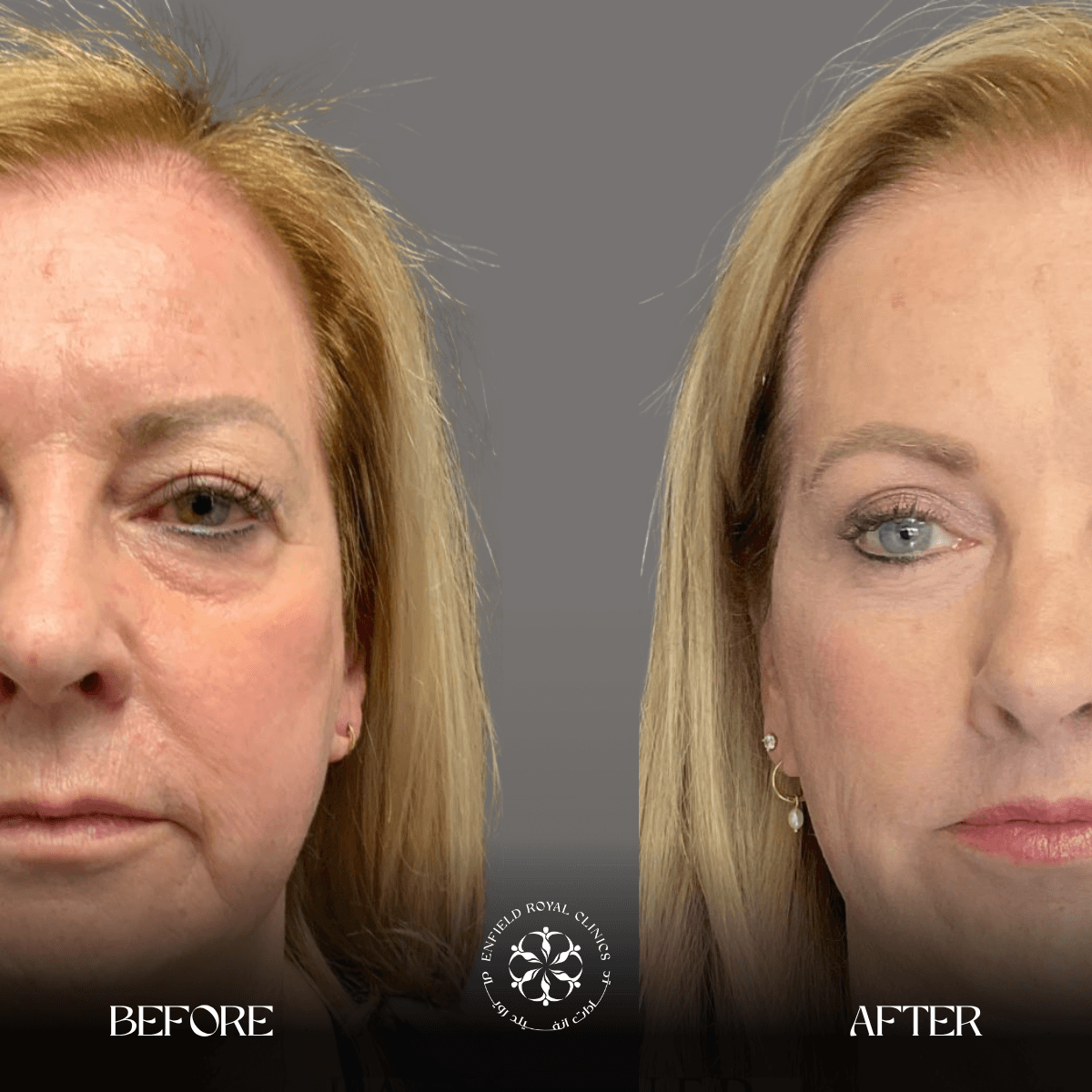 Eyelid Surgery in Riyadh & Saudi Arabia | Blepharoplasty
